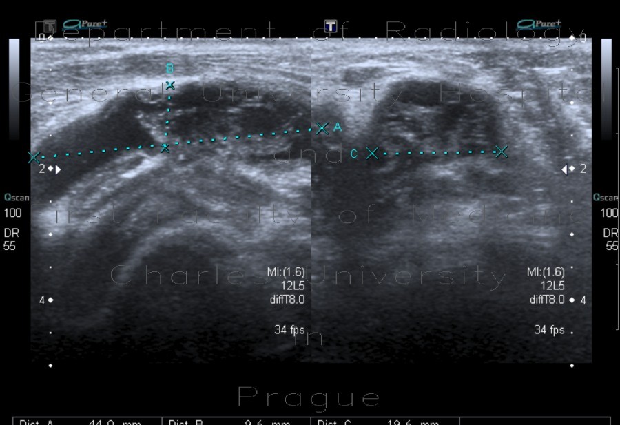 Radiology case: Baker's cyst, rupture