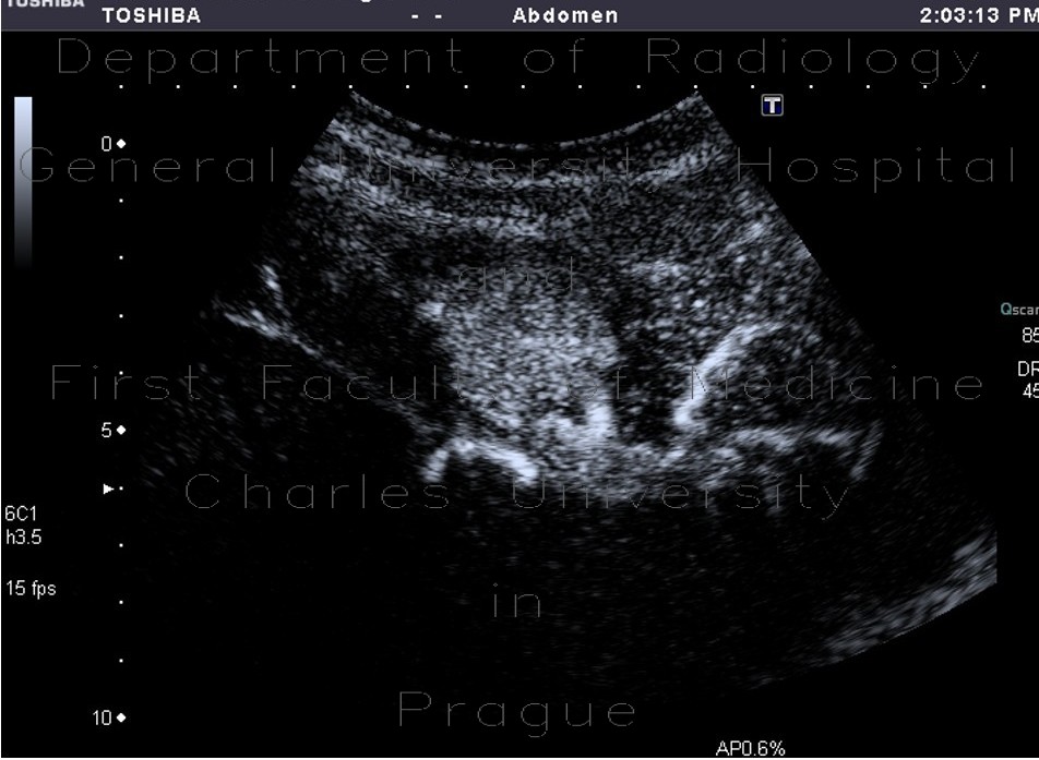 Radiology case: Focal nodular hyperplasia, FNH, CEUS