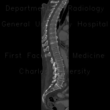 Radiology case: Schmorl's nodes