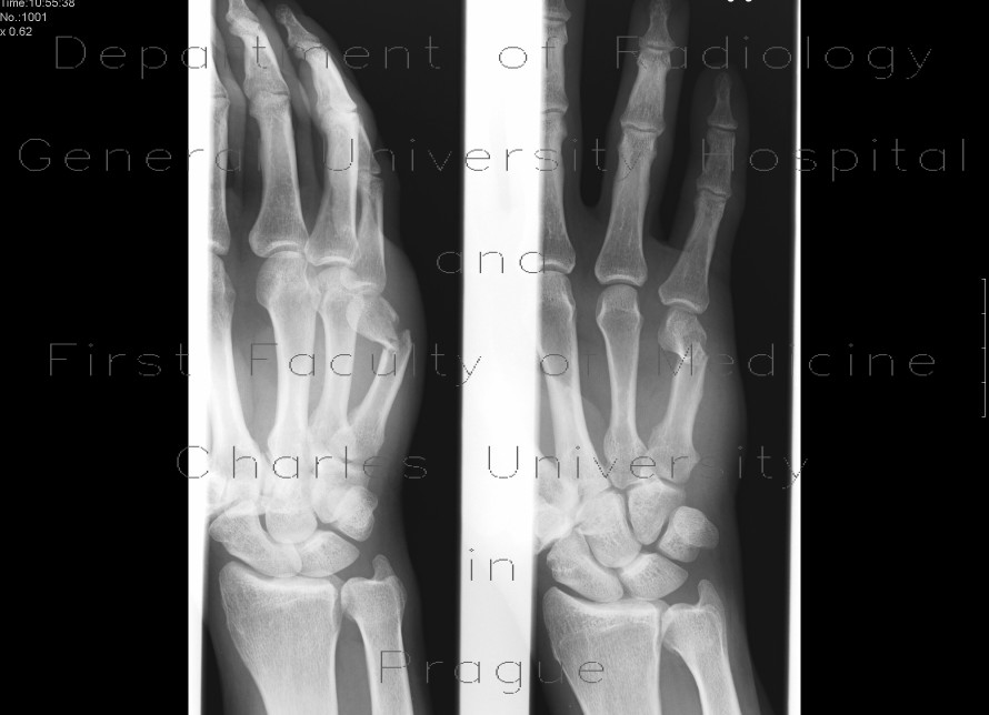 Radiology case: Subcapital fracture of the fifth metacarpal, Boxer's ...